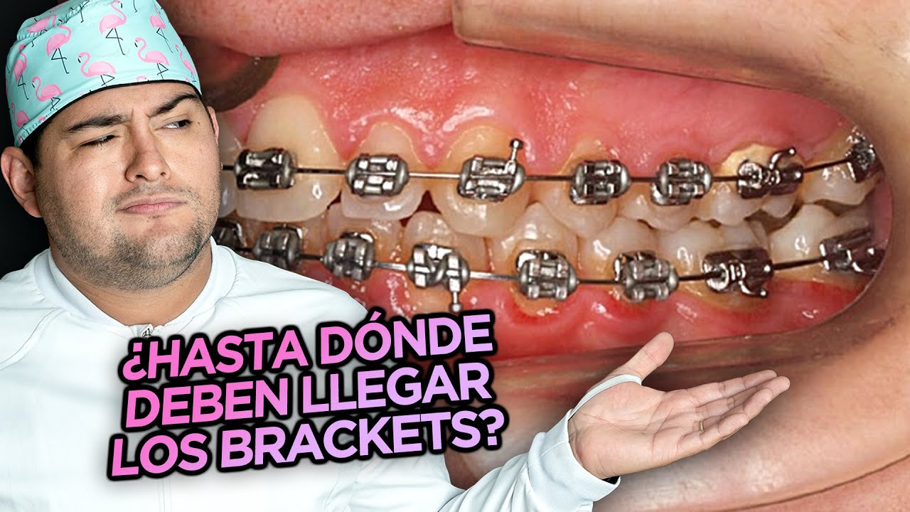 Descubre todo sobre los tubos en los brackets y cómo pueden beneficiar ...