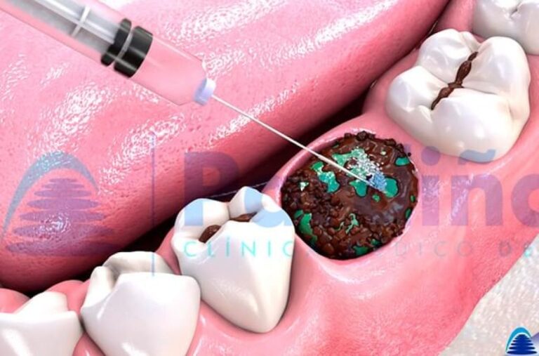 ¡Descubre cuánto dura el coágulo después de una extracción dental y evita complicaciones!