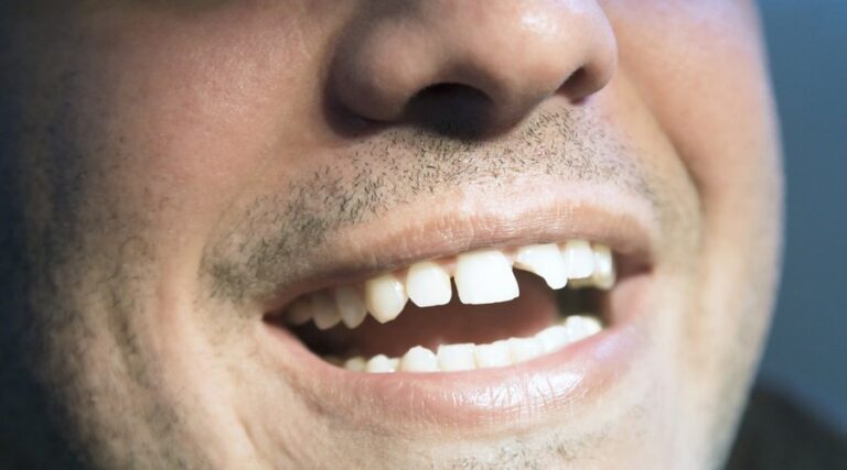 ¡Aprende cómo reparar una muela rota en casa y alivia el dolor de forma ...