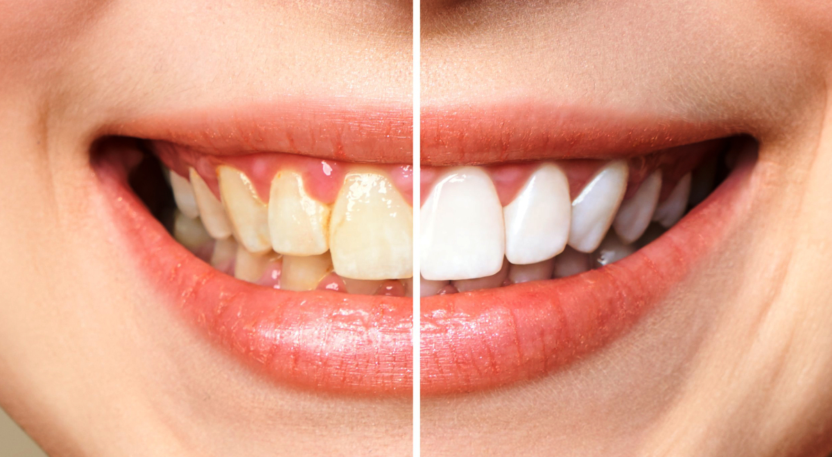 ¡Descubre cuánto cuesta una limpieza dental profunda y cómo ahorrar ...